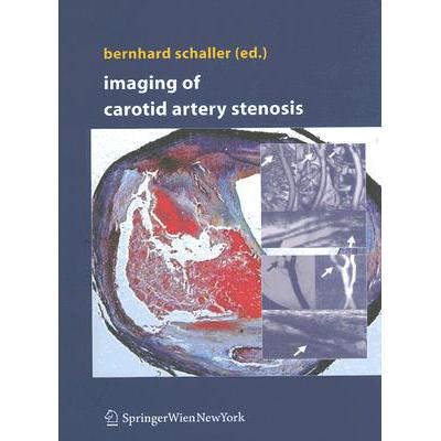 Imaging of Carotid Artery Stenosis