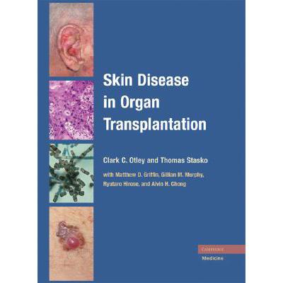 Skin Disease in Organ Transplantation