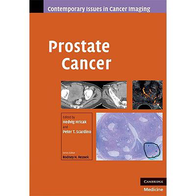 Prostate Cancer: - Prostate Cancer