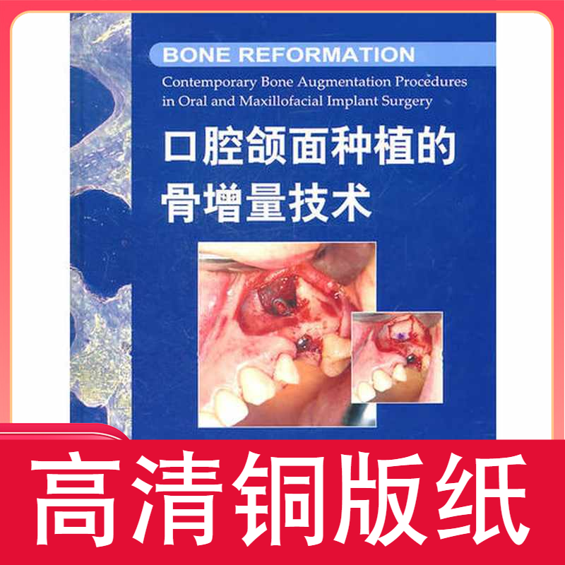 口腔颌面种植的骨增量 铜版纸