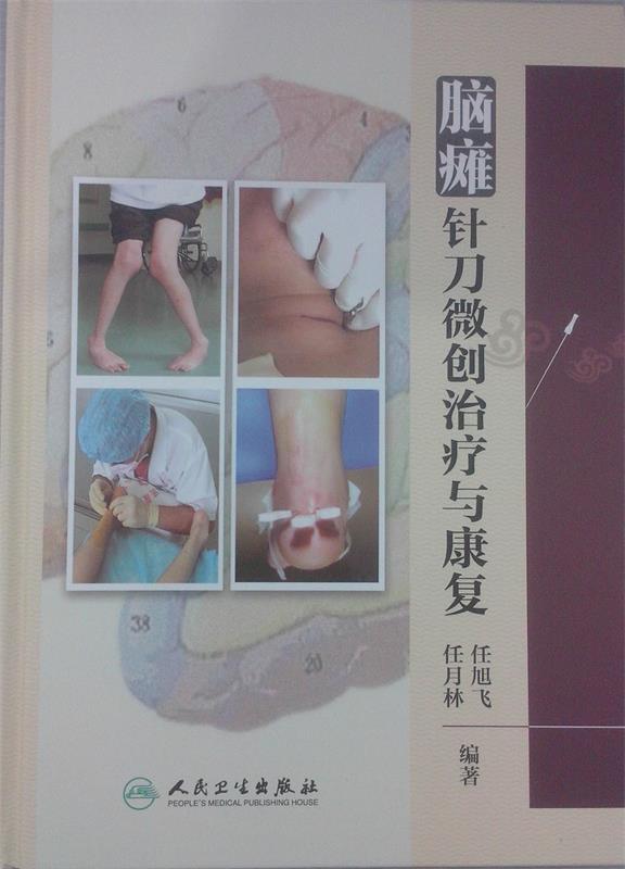 脑瘫针刀微创治疗与康复