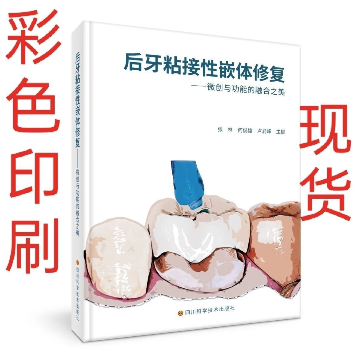 高清彩色 后牙粘接性嵌体修复 微创与功能的融合之美口腔修复补牙