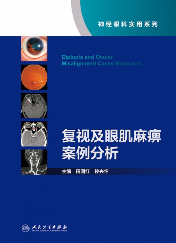 复视及眼肌麻痹案例分析（神经眼科实用系列）（配增值）