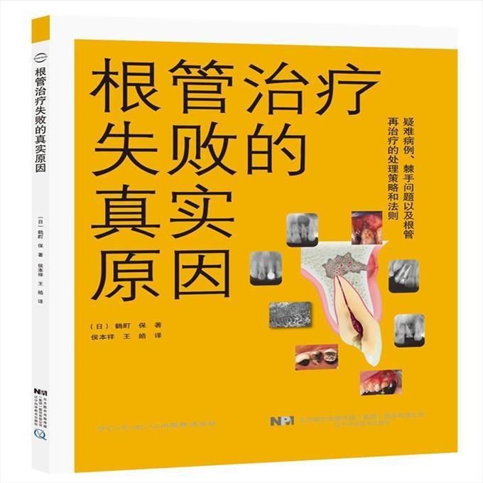 根管治疗失败的真实原因