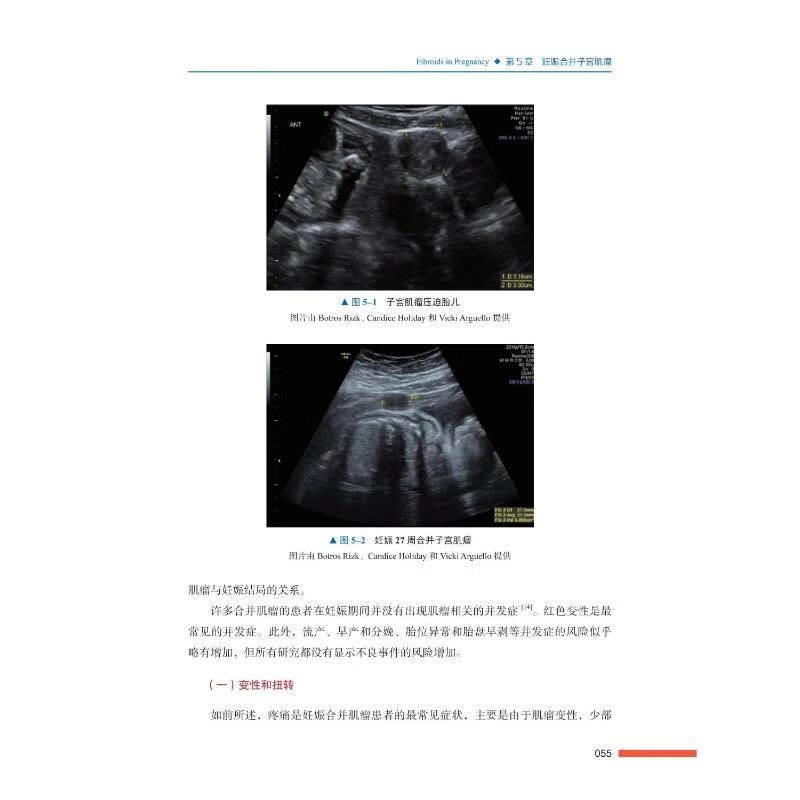 子宫肌瘤与生殖