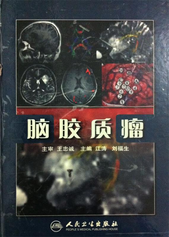 脑胶质瘤