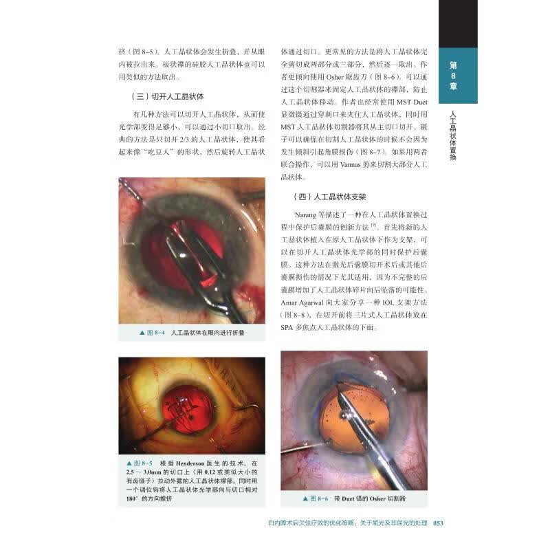 白内障术后欠佳疗效的优化策略 关于屈光及非屈光的处理