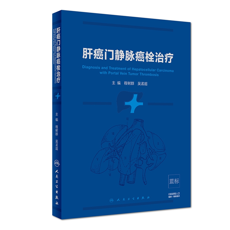 肝癌门静脉癌栓治疗