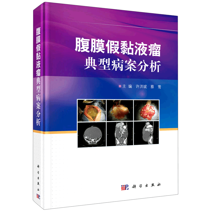 腹膜假黏液瘤典型病案分析(精)