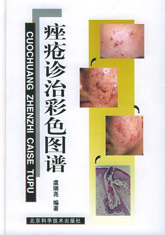 痤疮诊治彩色图谱 虞瑞尧 编著