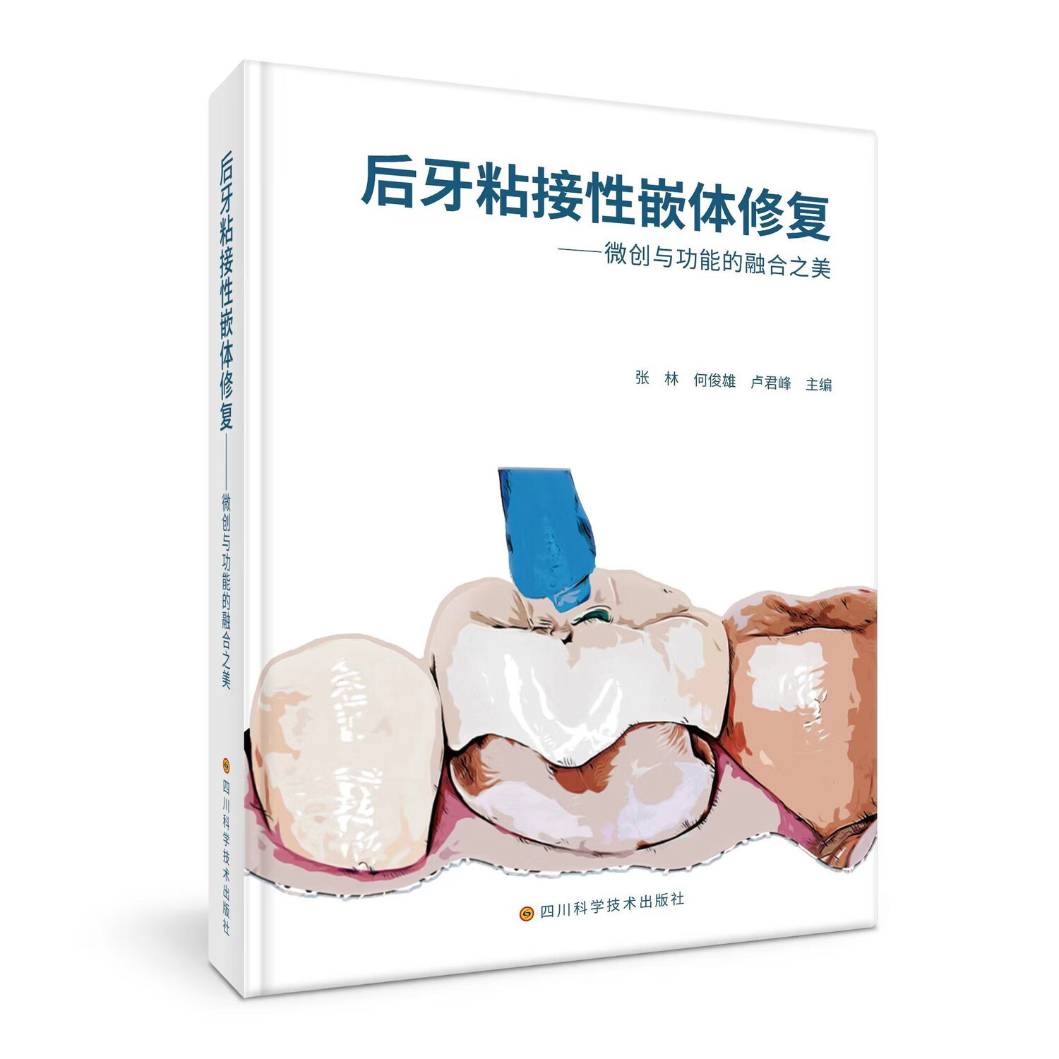 后牙粘接性嵌体修复 微创与功能的融合之美口腔修复补牙