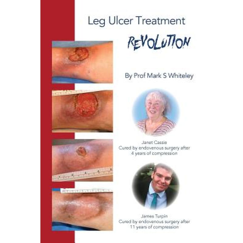 Leg Ulcer Treatment Revolution